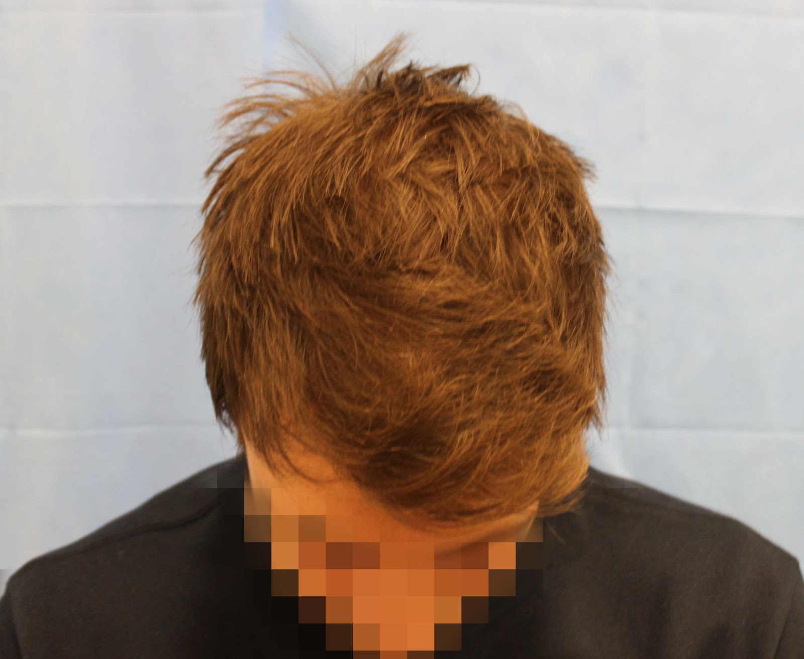 Selston Cosmetic Clinic: Diffuse Hair Loss....Before And After