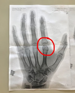 Tim Edberg: Broken knuckle