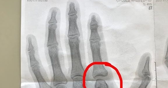 Tim Edberg: Broken knuckle