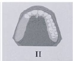 Klasifikasi Applegate-Kennedy | SERBA SERBI DENTISTRY