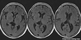 Dr Balaji Anvekar FRCR: Ependymal cyst MRI