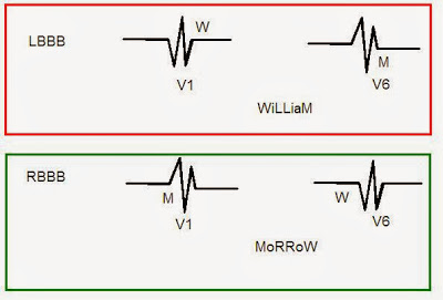 UG Aid: Left vs Right Bundle Branch Block
