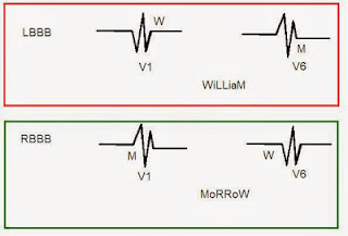 Left vs Right Bundle Branch Block