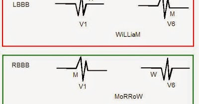 Left vs Right Bundle Branch Block