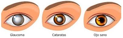 Oftalmologia: Noticias y tratamientos: Glaucoma: síntomas, tratamiento ...
