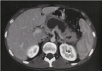 Atlas virtual de histologia e patologia: [CC #9]: PANCREATITE