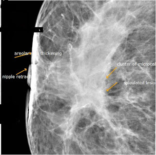Mammogram-Possible Malignancy - Sumer's Radiology Blog