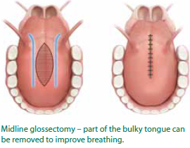 The Chronicles of Ellie Bellie Bear: Obstructive Sleep Apnea - surgical ...