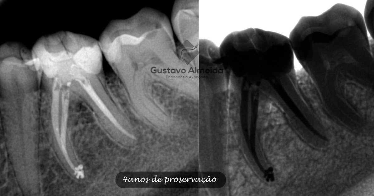 PERIODONTITE APICAL – LESÃO DE FURCA (CASO DO DIA) | Endo Gustavo Almeida