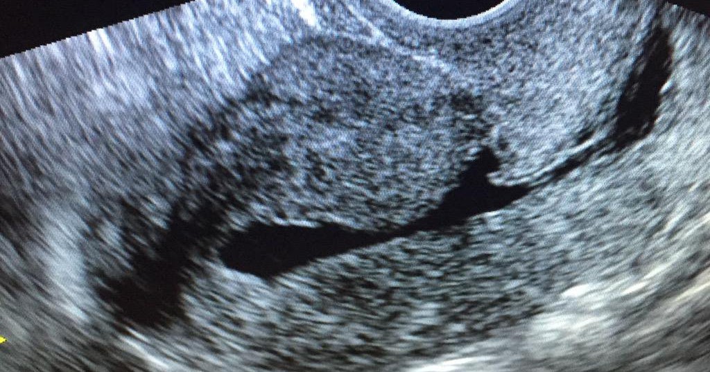 Cirugia Minima Invasiva Ginecologica: Diverticulo cervical o Itsmocele