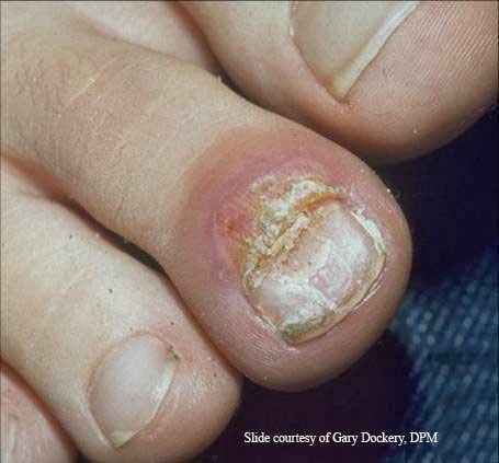 Periungual Warts Removal