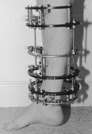 Deformutilation: The Ilizarov Frame