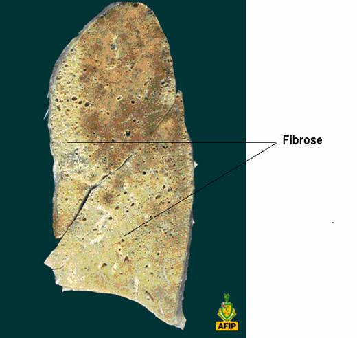 Blog do Pulmão: FIBROSE PULMONAR