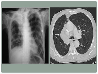Chest Medicine Made Easy-Dr Deepu: Important chest radiology signs.