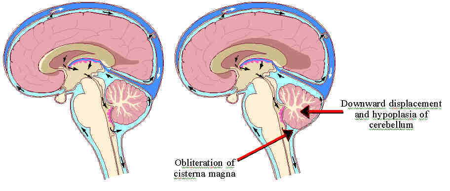 Understanding Williams Syndrome: Chiari Malformation
