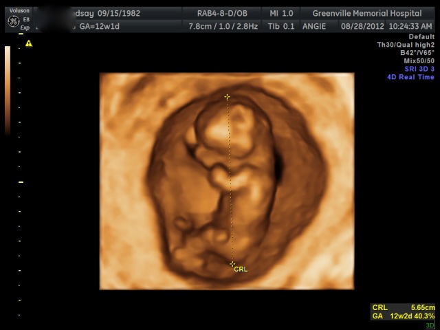 The Pregnancy – Or there and back again..: Nuchal Translucency Scan! 12 ...