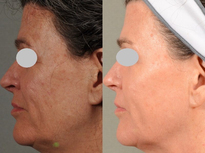 Complection Perfection