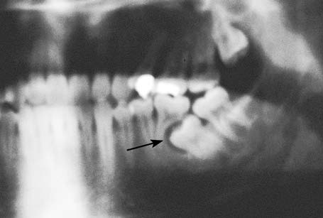 Dentistry and Medicine: Impacted Mandibular 3rd Molar Classification ...