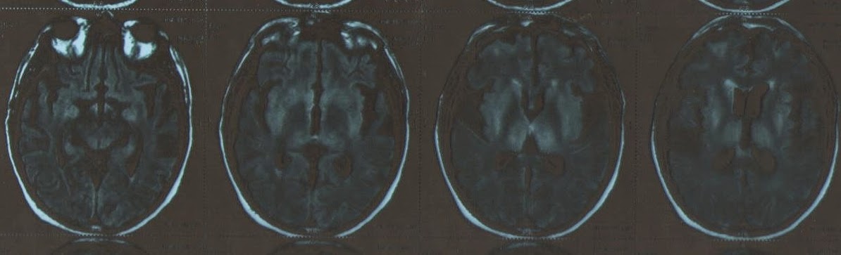 Hypoxic Brain Injury-MRI - Sumer's Radiology Blog