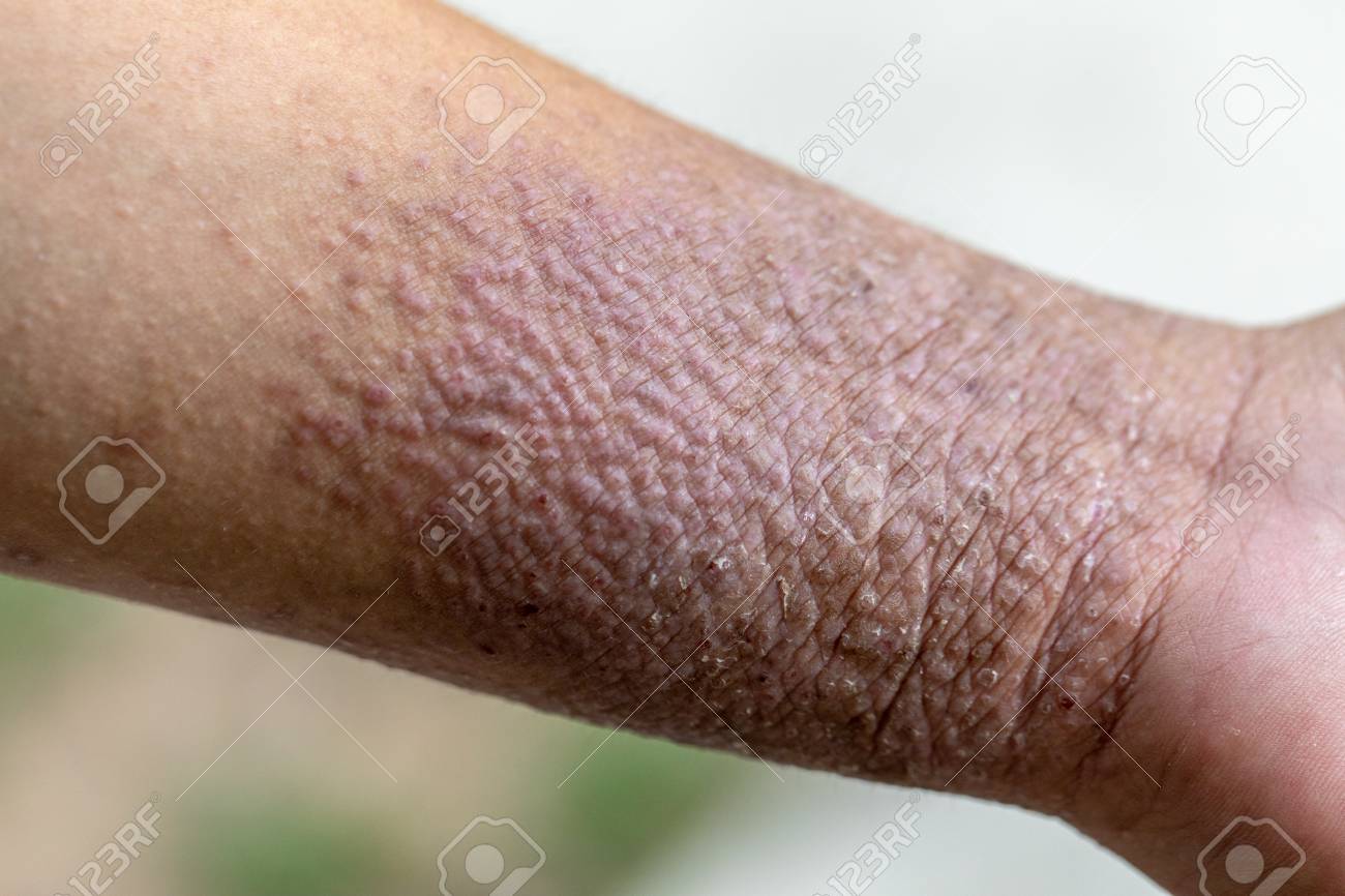 What Is Atopic Eczema? - Teroes