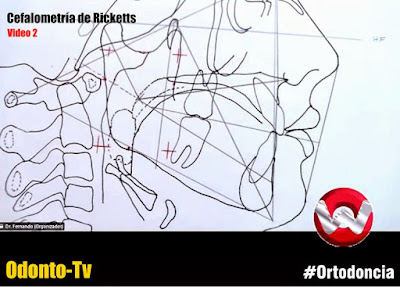 ORTODONCIA: Cefalometría de Ricketts - Video 2 - Odonto-Tv
