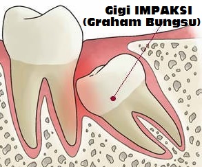 Pencabutan Gigi Bungsu (Bedah Odontektomi)