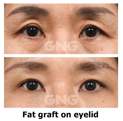 GNG Plastic Surgery Hospital: Eyelid Fat Surgeries make your face ...