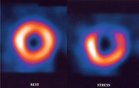 CIENCIASMEDICASNEWS: Nuclear (Thallium) Stress Test - Texas Heart ...