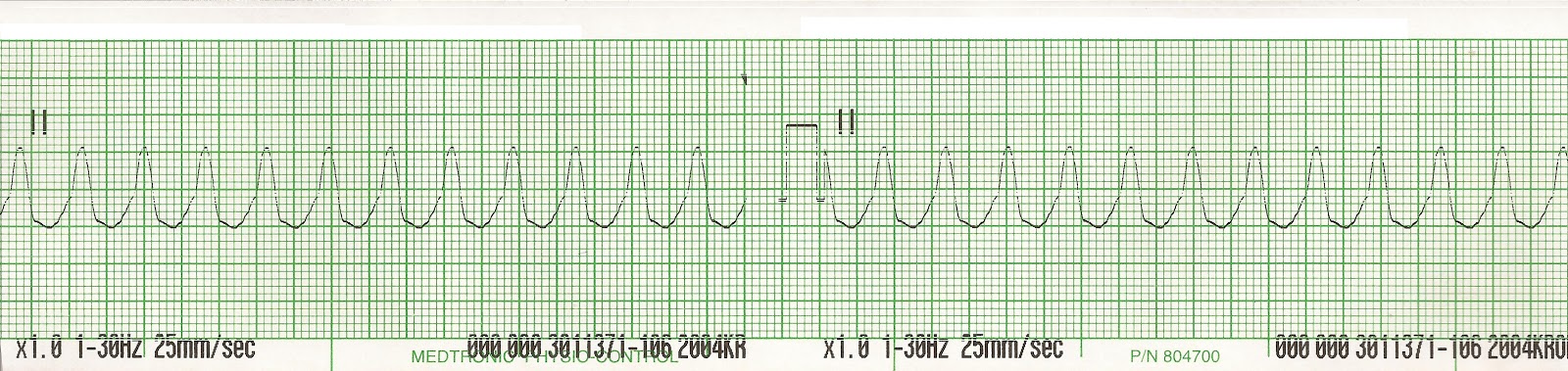 Float Nurse: Pulseless VF/VT