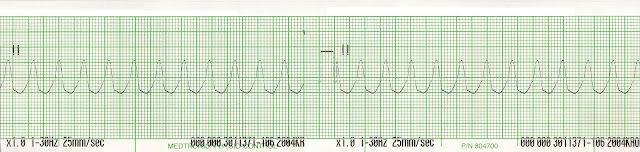 Float Nurse: Pulseless VF/VT