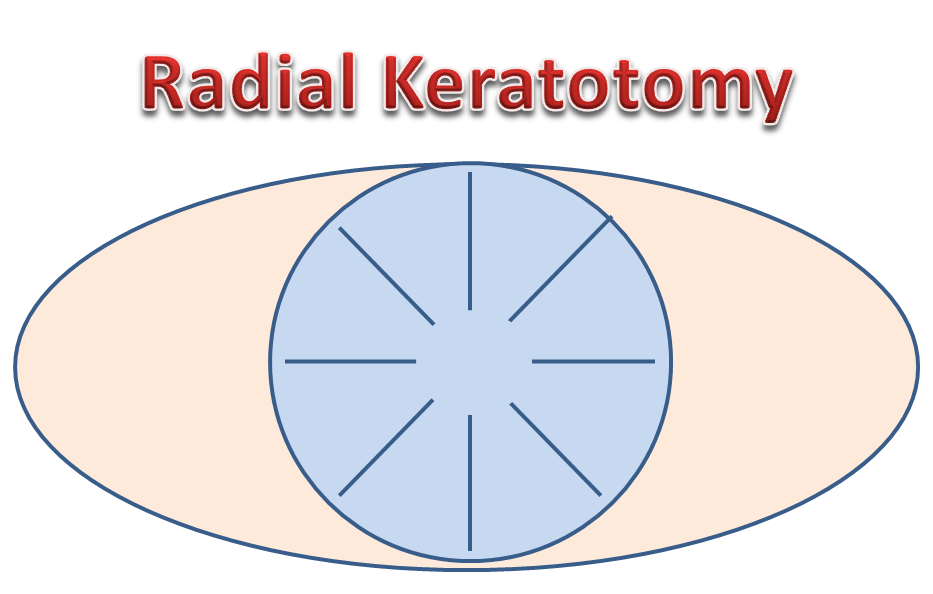 A Cure for Near Sightedness - Radial Keratotomy ~ Gainesville Health ...