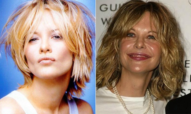 Quinta-Feira 12: Famosas que colocaram botox - veja o antes e depois