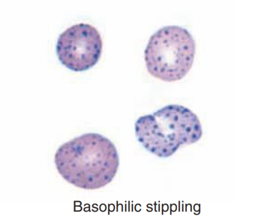 Fichero Hematológico: Anormalidades de la línea celular eritroide