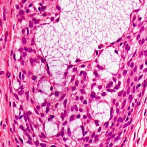 Dermatopathology Case 97