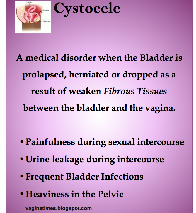 Vagina Times Magazine : Cystocele Free Download Informational Guide