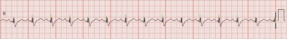 EKG Rhythm Strip Quiz 56: Paced Rhythms