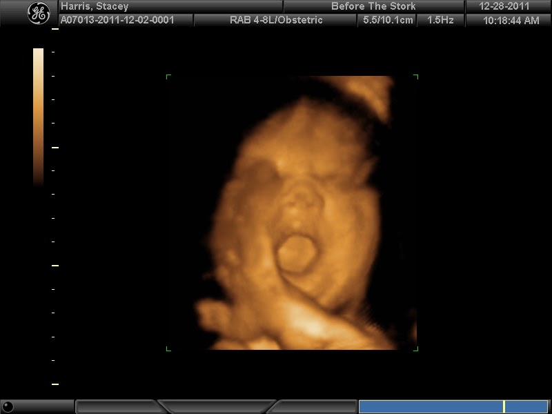 .: 32 Week 3D Ultrasound