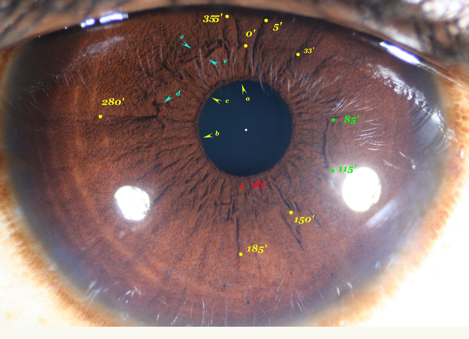 Modern & Multidimensional Iridology: Koch's Sign & Localised ...