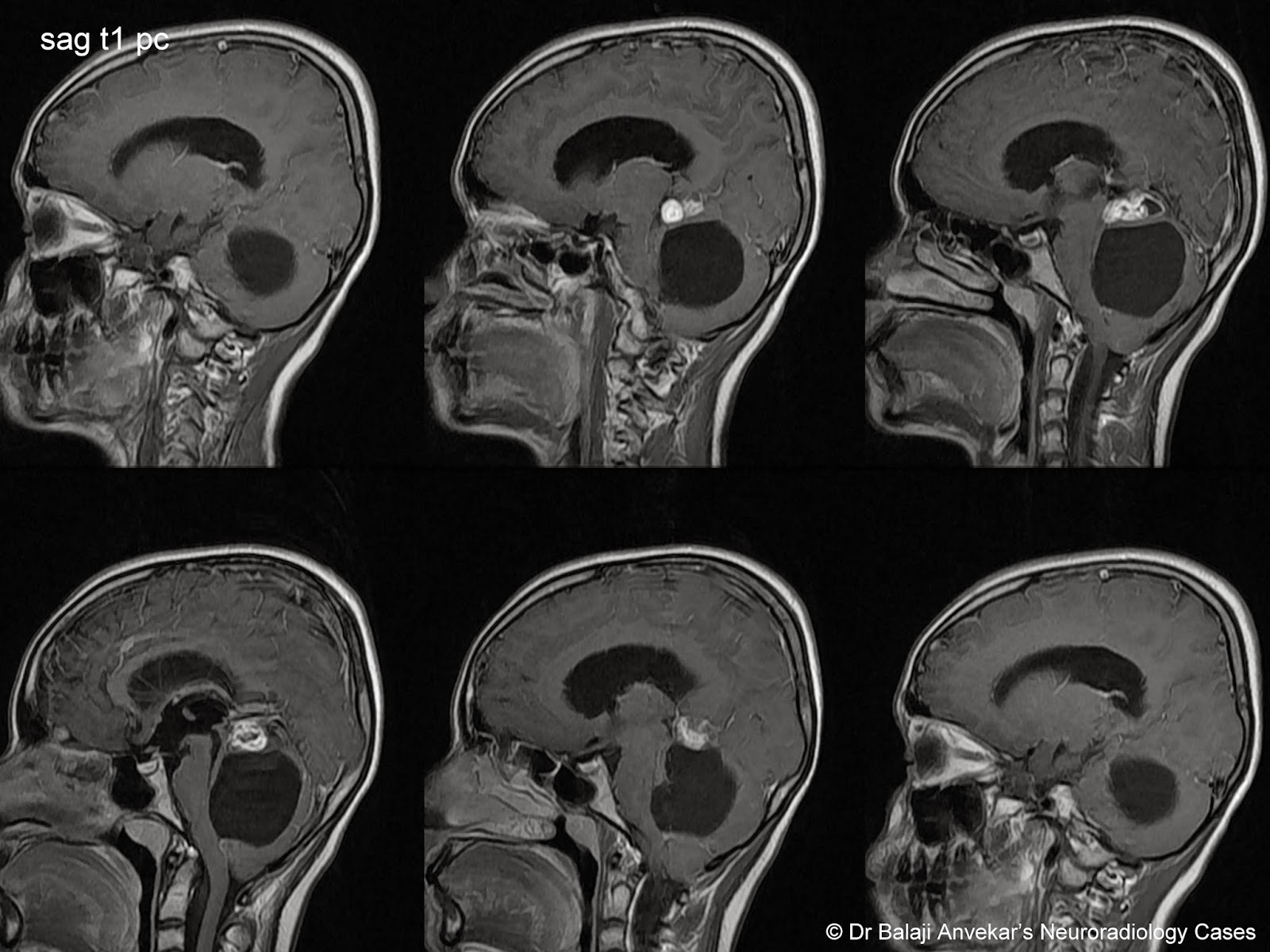 (PPTX) Presentation1.pptx, radiological imaging of hydrocephalus ...