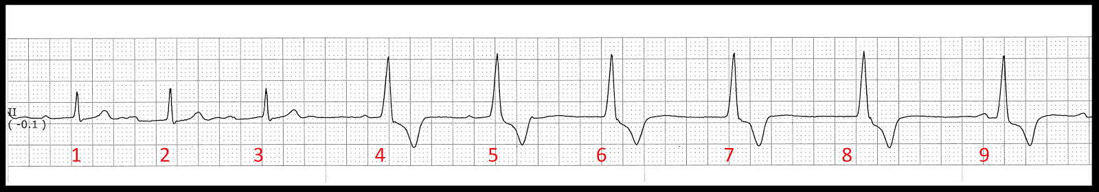 Practice EKG Stirp