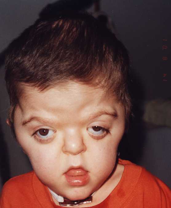 Blog do Educador: Síndrome de Turner