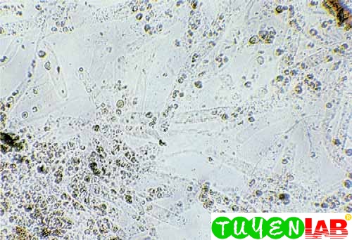 Atlas of Casts in urine | Free Medical Atlas