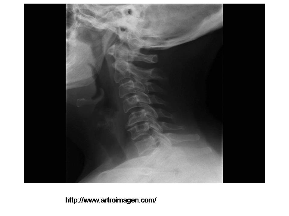 Diagnóstico de la artrosis
