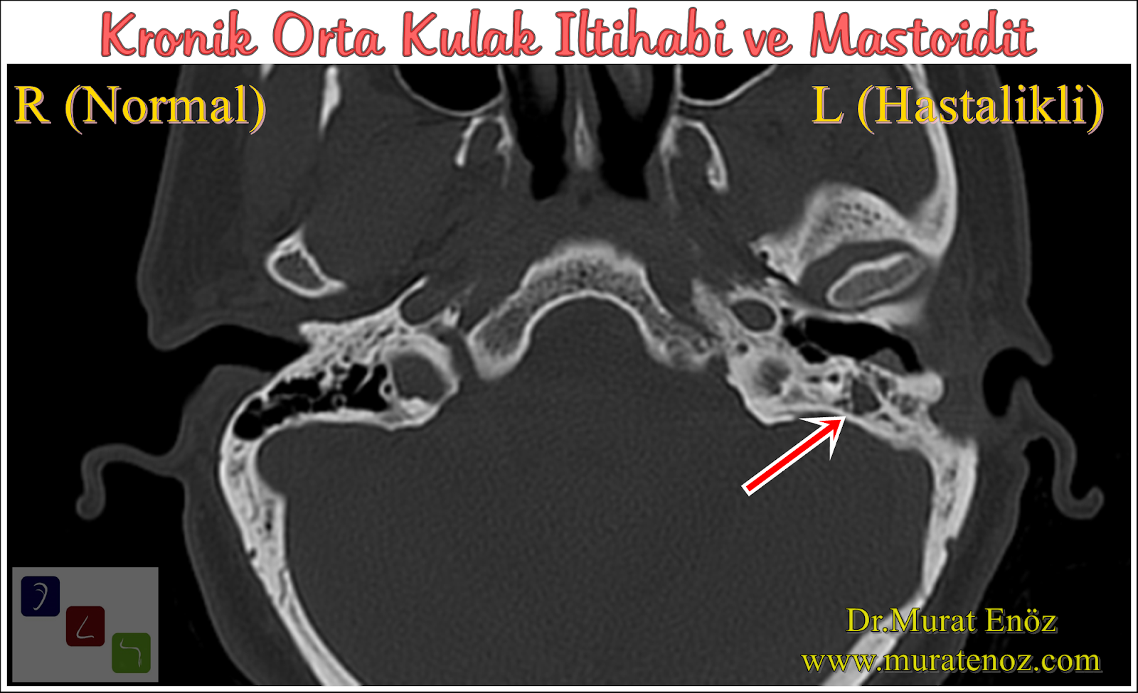 Kronik Orta Kulak İltihabı ve Mastoidit