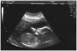 WactyReen: Makalah Tentang USG ( Ultrasonografi )