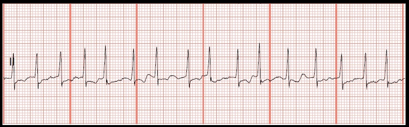 Practice EKG Rhythm Strips 111