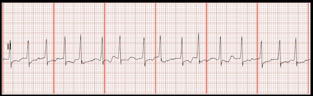 Practice EKG Rhythm Strips 111