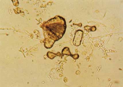 [Haematology] Microscopic Examination of Urinary Sediment - Crystals ...