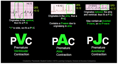Paramedic Student Central: PVC, PAC, PJC Quick Reference Tool