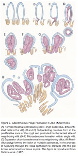 FAP Colon Cancer: Adenomatous Polyp Formation